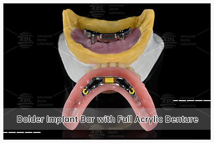 Dolder Implant Bar with Full Acrylic Denture